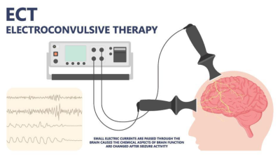 Apa Itu ECT? - Mediaperawat.id